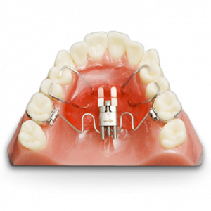 Orthodontics - Arcari Dental Laboratory – Full Service