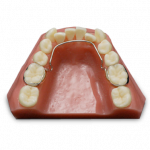 Space Maintainers - Arcari Dental Laboratory – Full Service
